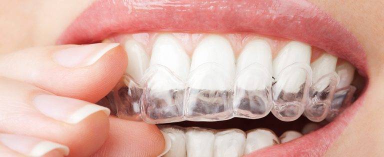 Kosmetisk Tandvård - Stjärntandläkarna AB Tandläkare & Tandhygienist ... Kosmetisk Tandvård - Stjärntandläkarna AB Tandläkare & Tandhygienist ...